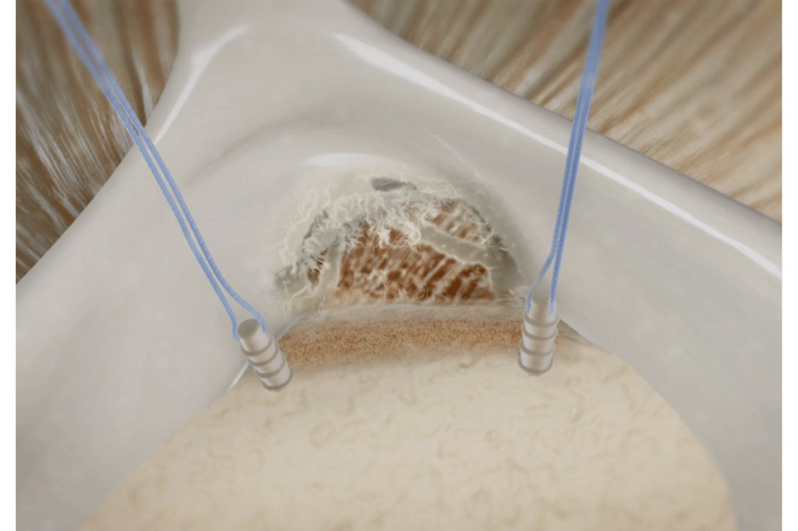 SLAP Lesion Repair - Doç. Dr. Gökhan Karademir